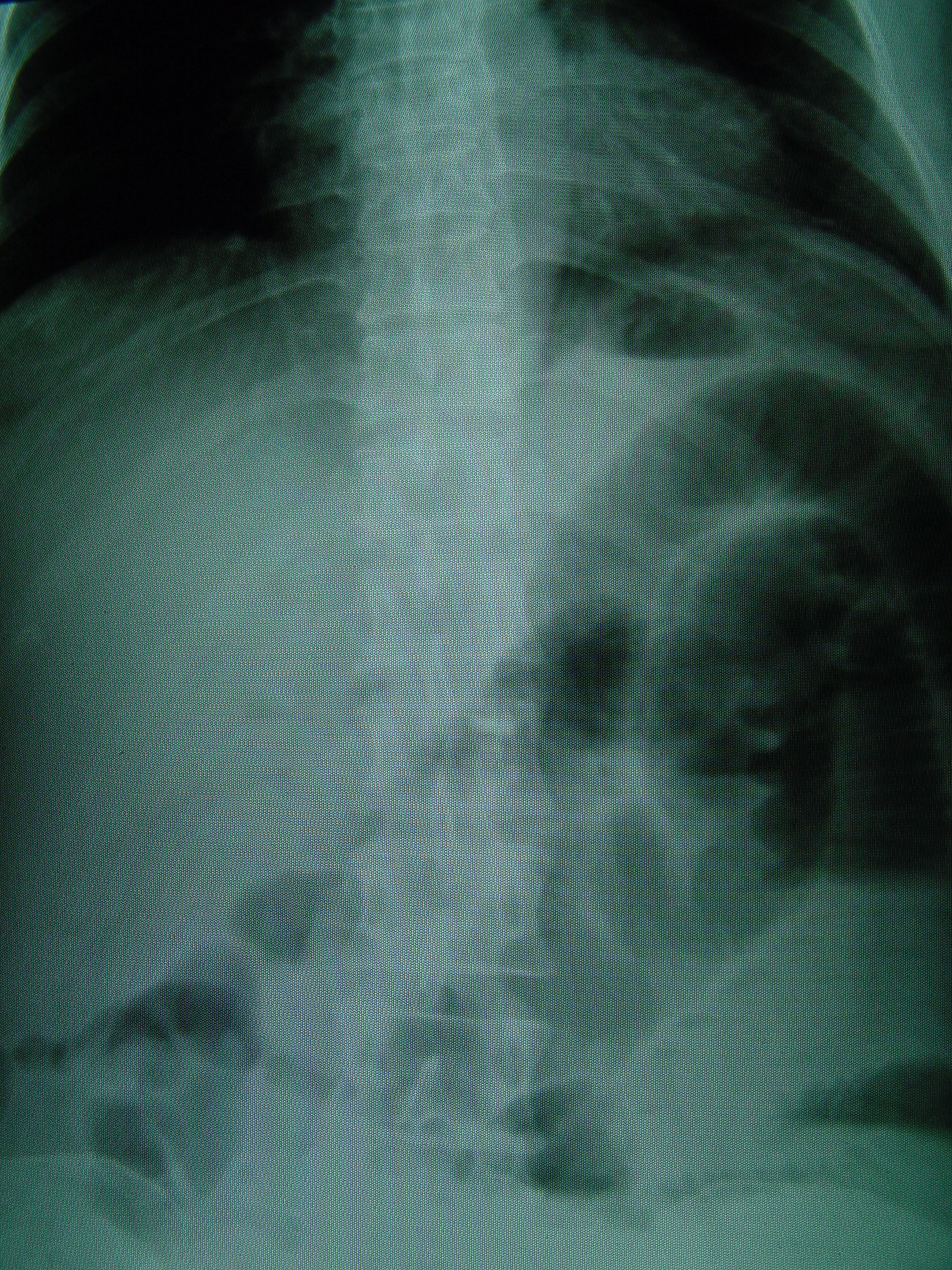 Small Bowel Obstruction 3791 Small Bowel Obstruction 1 Surgery Photos